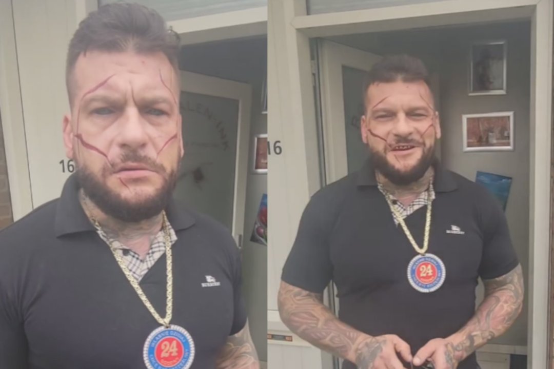 Popek z czerwonymi bliznami na twarzy. Fanów niepokoją jego kolejne ...