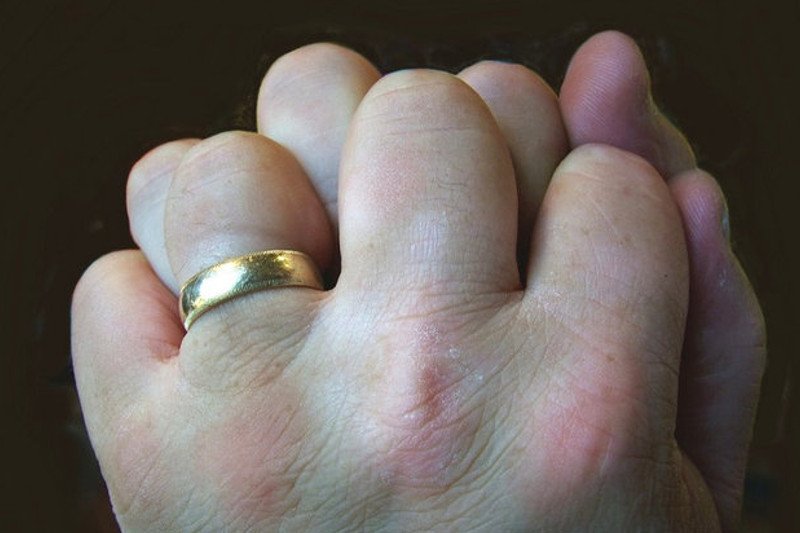 „Strzelasz” palcami u rąk? Zobacz, co się dzieje z twoimi stawami ...